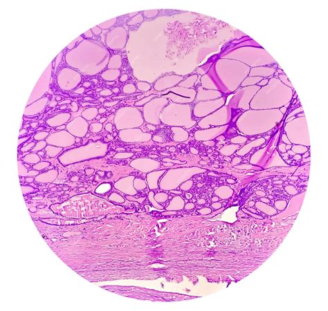 Premium Photo Synovial Sarcoma Histology Image Analyzed By Microscope At Histopathology