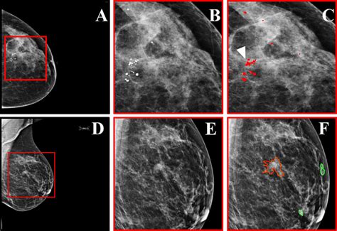 Dataset Examples A D Mammographic Views Of Women With Benign And Download Scientific Diagram