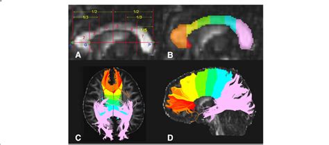 Subregions Of The Corpus Callosum Segmentation Scheme Of The Corpus