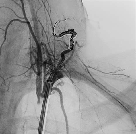 Embolization Of A Massage Gun Induced Pseudoaneurysm In The