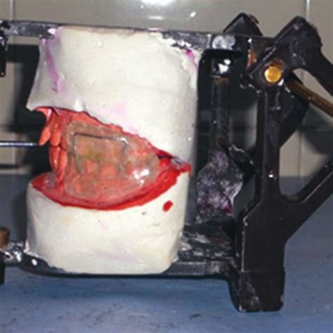 Preoperative Photograph Fig 2 Guide Flange Prosthesis Over Download Scientific Diagram