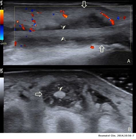 Infectious Tenosynovitis Of The Foot Extensors Reumatología Clínica English Edition