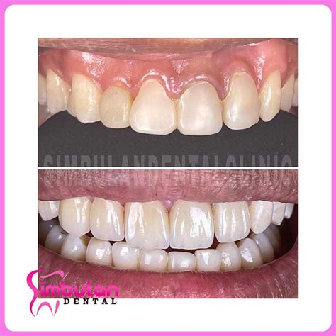 The Veneer Application Process Simbulan Dental Clinic The Veneer Application Process Simbulan Dental Clinic