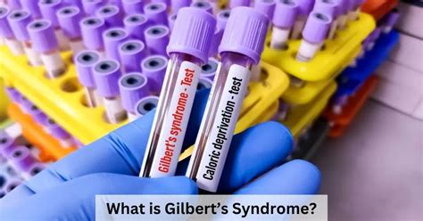 What Is Gilbert Syndrome Know All About The Condition Affecting Joey Graziadei