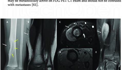Juxtacortical Chondroma Frontal Radiograph Of The Left Tibia And