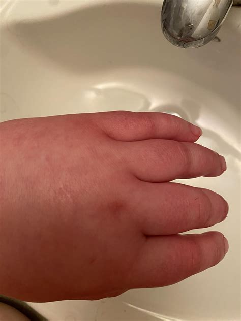 Cts Open Release Trigger Finger Normal Swelling Rcarpaltunnel