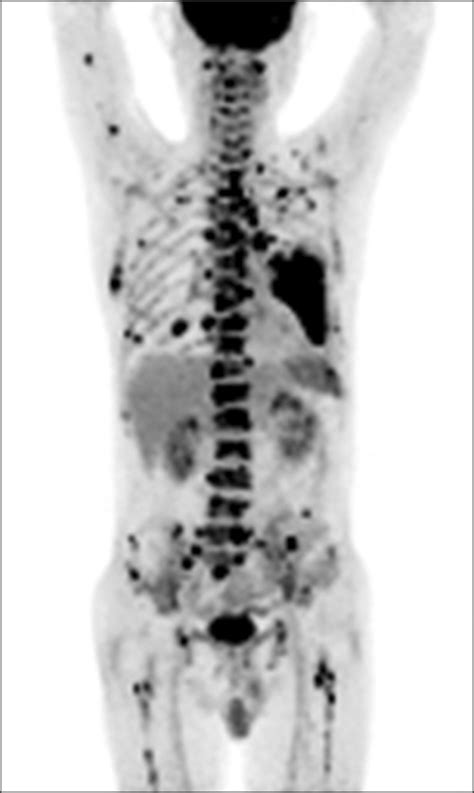 Maximum Intensity Projection Image Of F 18 Fluorodeoxyglucose Download Scientific Diagram