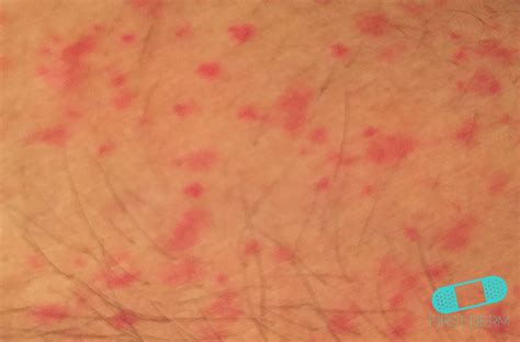 Urticarial Vasculitis Icd 10