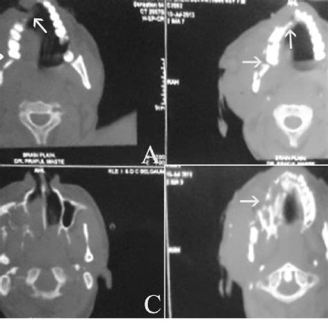 Ct Scan Pictures Depicting The Mandibular Fractures A And B Download Scientific Diagram