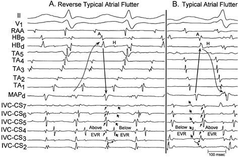 Role Of The Tricuspid Annulus And The Eustachian Valveridge On Atrial