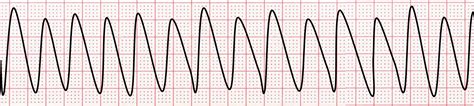 Polymorphic Ventricular Tachycardia Vs Ventricular Fibrillation Polymorphic Ventricular Tachycardia Vs Ventricular Fibrillation