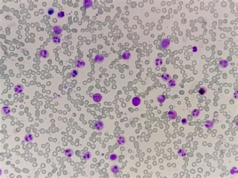 Premium Photo Microscopic 100x View Of Chronic Myelocytic Leukemia Or Cml