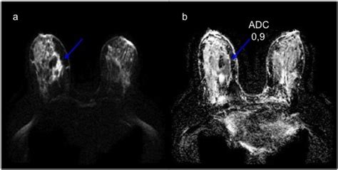 MRI A Diffusion Weighted Sequence B ADC Map Download Scientific Diagram