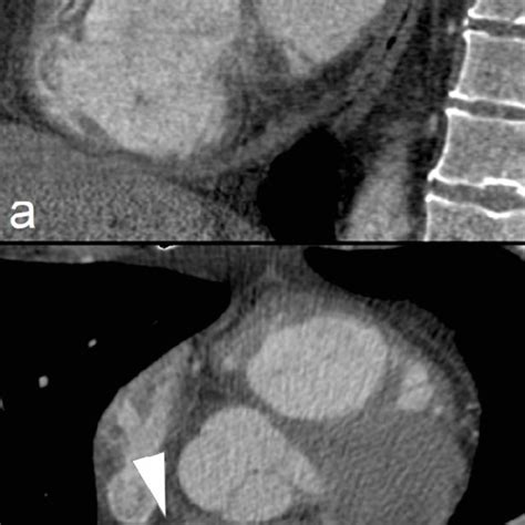 Helical Non Gated Mdct In A The Sagittal And B The Axial Plane The Download Scientific