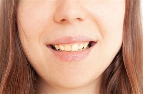What Does Anorexia Teeth Look Like 7 Important Tips
