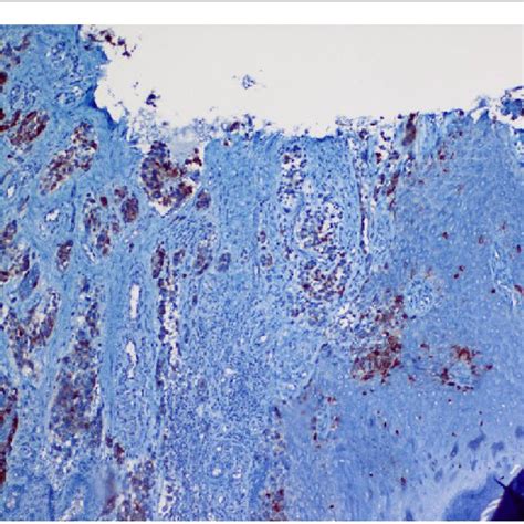 The Patients Toe After Excision Download Scientific Diagram