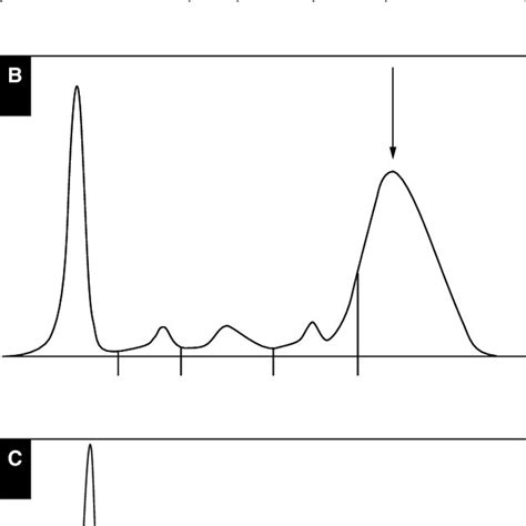A Capillary Electrophoresis Pattern From A Patient With A Serum