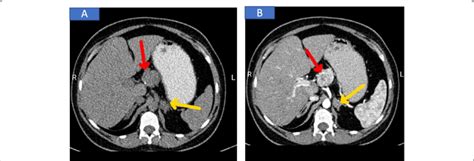 Without Contrast A And With Contrast B Axial Contrast Enhanced Ct
