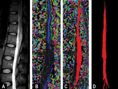 Diffusion Tensor Imaging In Spinal Cord Compression Wei Wang Wen Qin
