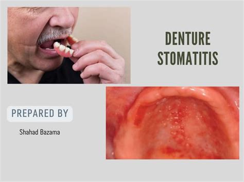 Denture Stomatitis Denture Hygiene Why When And How