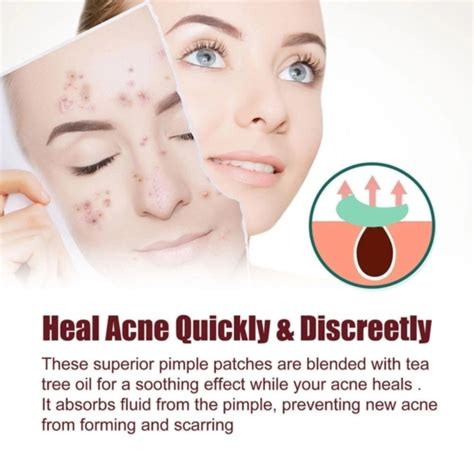 Jaysuing Acne Pimple Patch Professional Grade 200pcs Shoppelk
