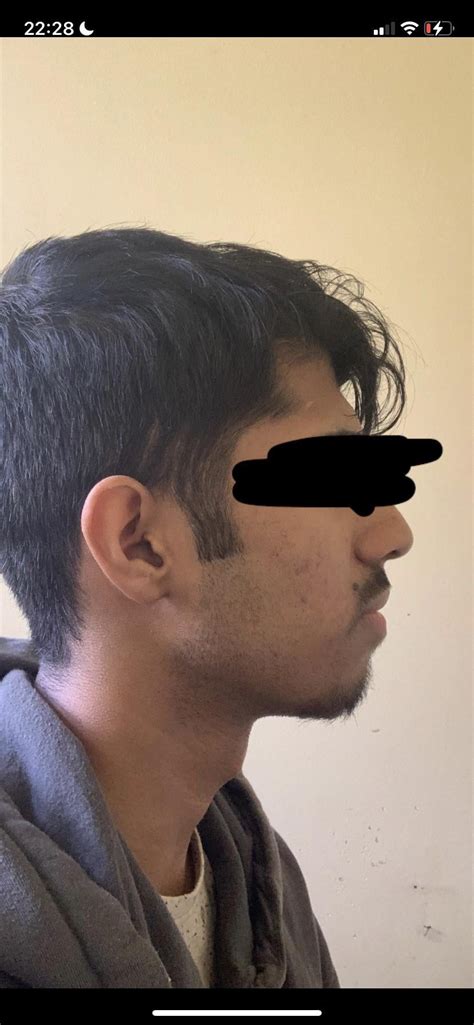 Posted Before Is My Maxilla Recessed Also Any Other Problems Im On