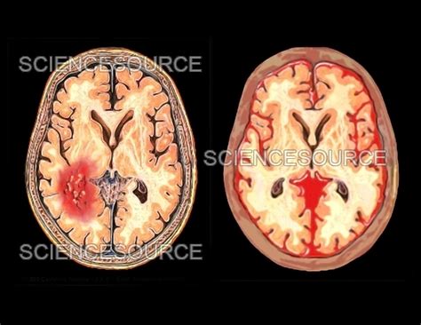 Brain Subarachnoid Hemorrhage Subdu Stock Image Science Source Images