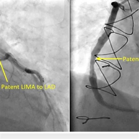 Retrograde Flow From The Lad To Lima And Back To The Left Sa Lad Left