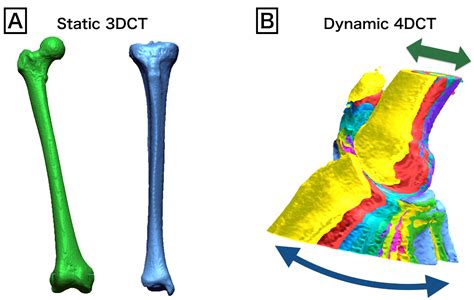 Four Dimensional Ct Analysis Using Sequential 3d 3d Registration