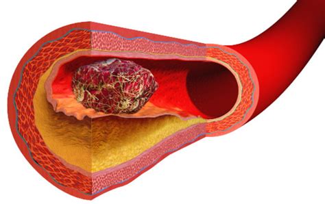 D Dimer During Pregnancy Increased Causes Of High Values After Embryo