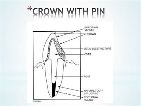 Artificial Crowns Temporary Crownspdf