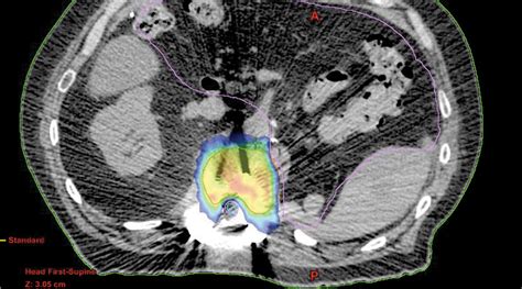 Spine Sbrt Radiology Key