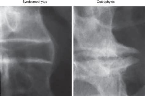 Spondyloarthrite