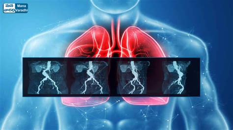 Pulmonary Angiogram పల్మనరీ యాంజియోగ్రామ్ ఎందుకు ఎలా చేస్తారు