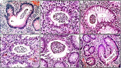Presence Of Goblet Cells In Colon Crypts With Inflammatory Abscesses Download Scientific