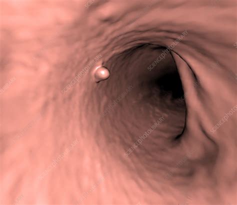Colorectal Polyp 3d Ct Scan Stock Image C0479264 Science Photo