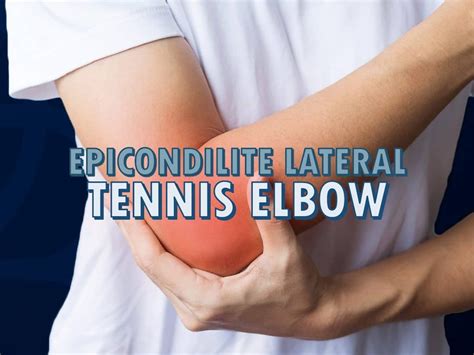 Tratamento Da Epicondilite Lateral Portal Doutor Meirelles®