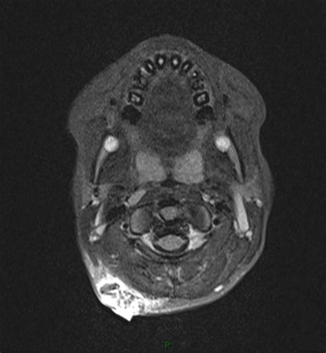 Rare Case Of Multiple And Perforating Pilomatrixomas In A Young Girl With Lymphovascular