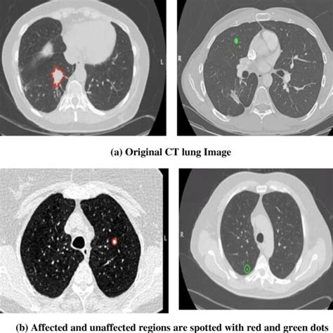 ct lung image with affected and unaffected region after segmentation
