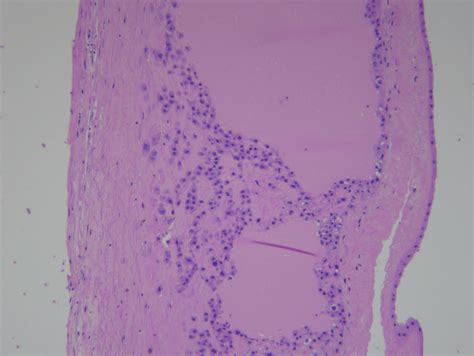 Placental Abruption Pathology