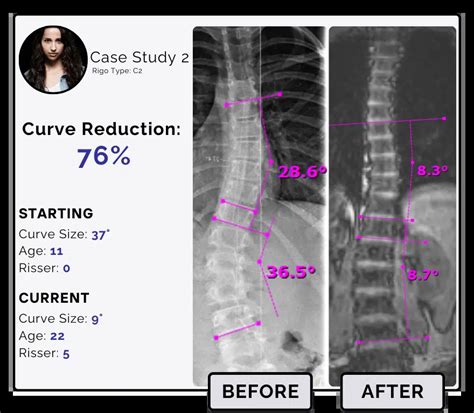 Results By Curve Reduction Scoliosis Care Centers