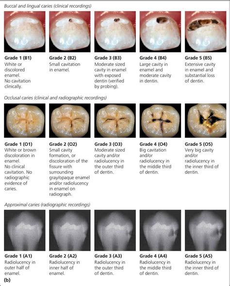 Dental Caries Lesions At Don Damian Blog