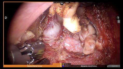 Prostate Cancer Surgery Cancerwalls