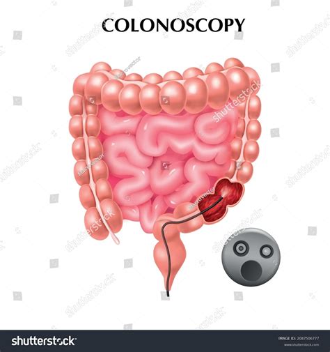 Colonoscopy Procedure Colored Poster Intestine Anatomy Stock Vector
