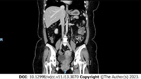 Figure 1 From Unusual Phenomenon Polyp” Arising From A Diverticulum A Case Report Semantic