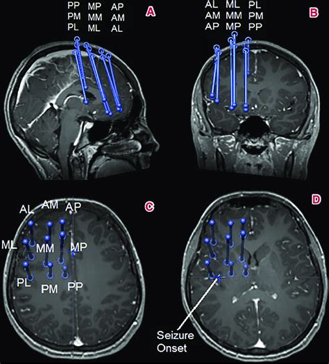 Diagram Of Depth Electrode Implantation And Orientation Of Frontal