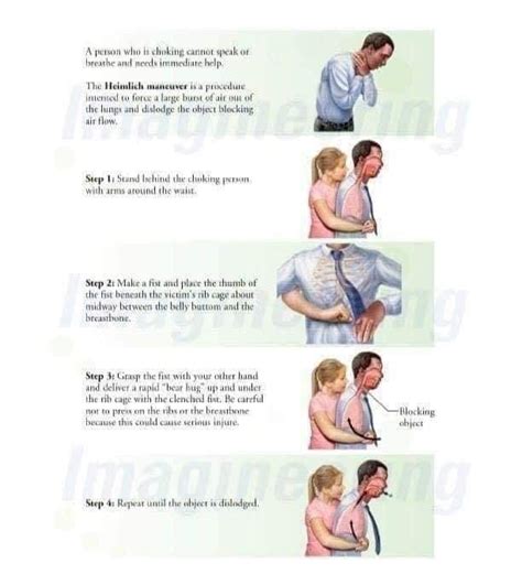 Manevra Heimlich Este Metoda De Kinetoterapie Medgidia Facebook
