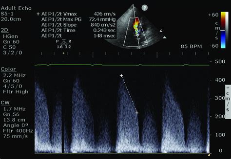 Spectral Doppler Bioprosthetic Av Replacement Aortic Regurgitation Download Scientific Diagram