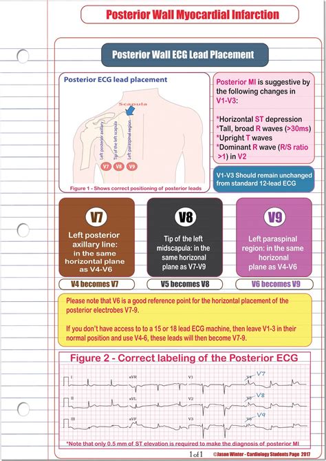12 Lead Ecg Placement Color