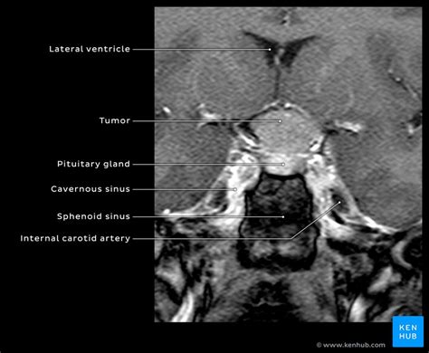Optic Neuropathy Due To Optic Compression Clinical Case Kenhub
